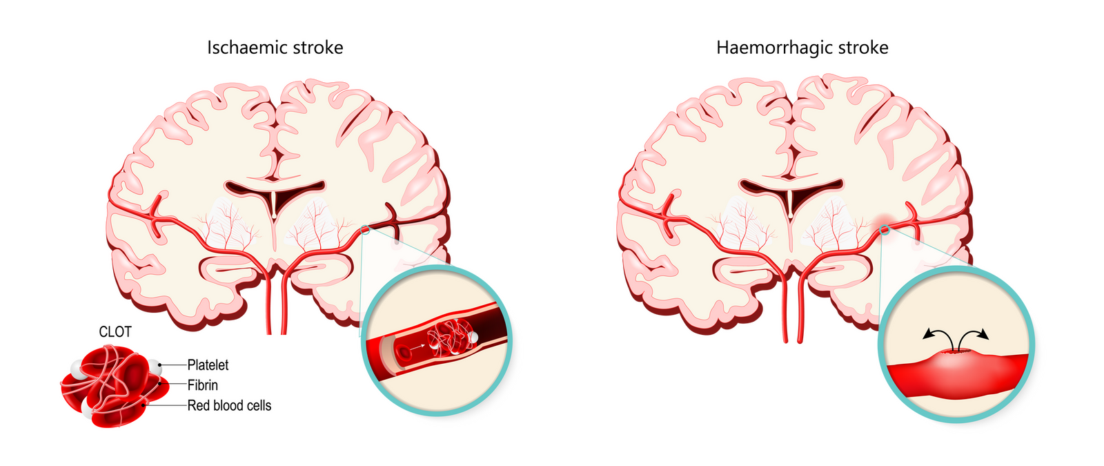 Stroke: symptoms, causes, prevention • Heart Research Institute